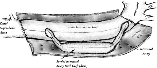 经验分享：胸腹主动脉瘤开放手术的器官保护