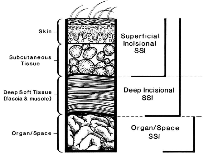 手术部位感染预防指南(2014最新版)