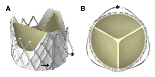 重度非钙化主动脉瓣反流：经胸主动脉瓣膜置换术怎么做？